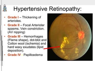 Pathology of Hypertension | PPT