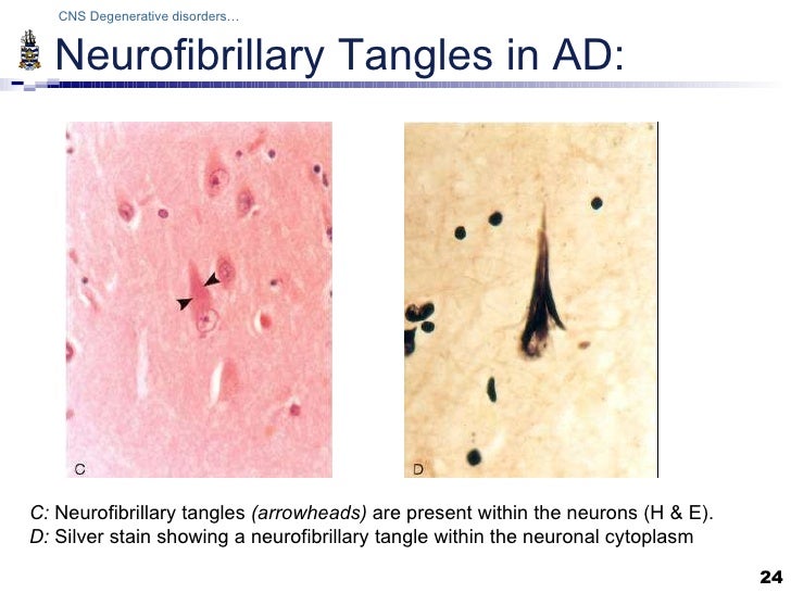 Pathology of CNS degenerations