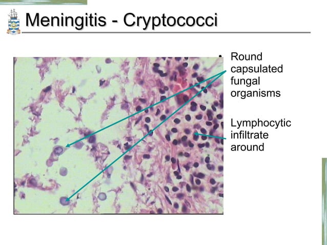 Pathology of Meningitis & CNS infections. | PPT