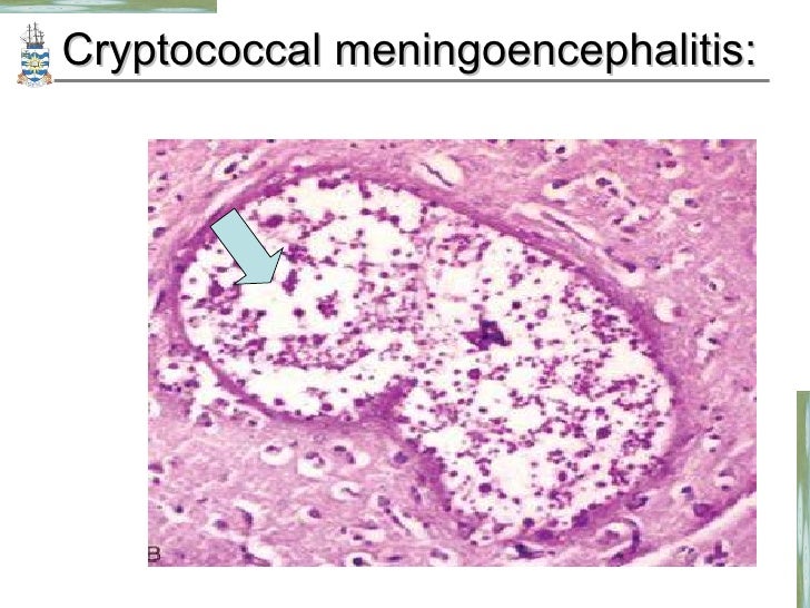 Pathology of Meningitis & CNS infections.
