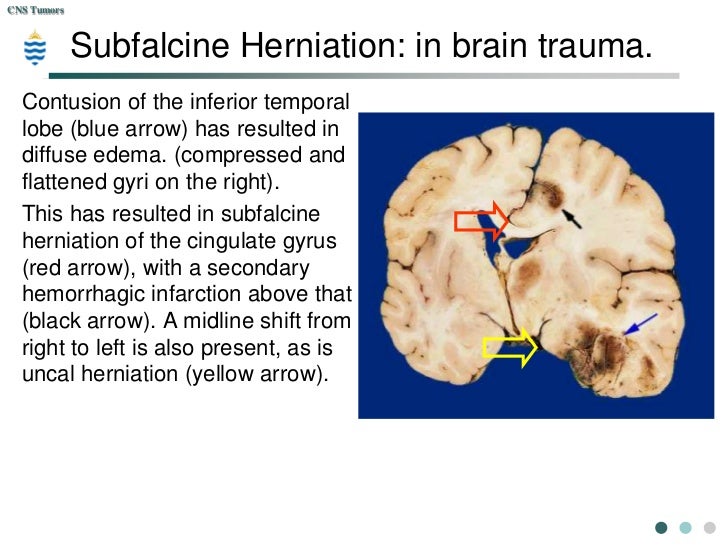 Pathology of CNS Tumours - Lecture