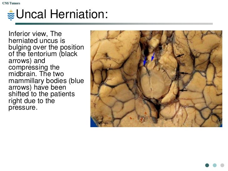 Pathology of CNS Tumors