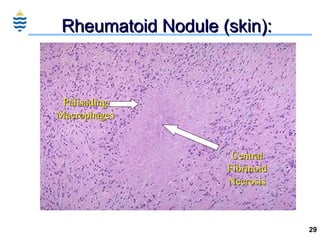 Pathology of Arthritis | PPT