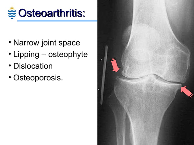 Pathology of Arthritis | PPT