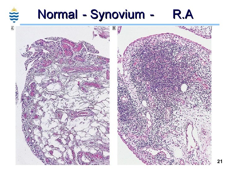 Pathology of Arthritis