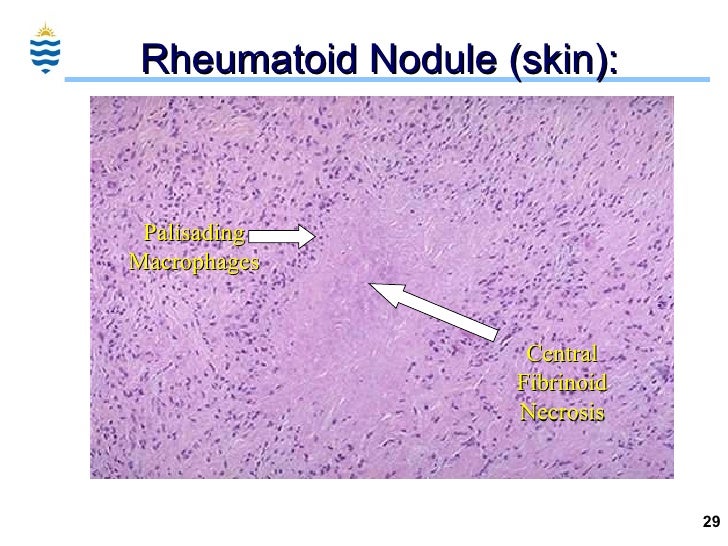 Pathology of Arthritis