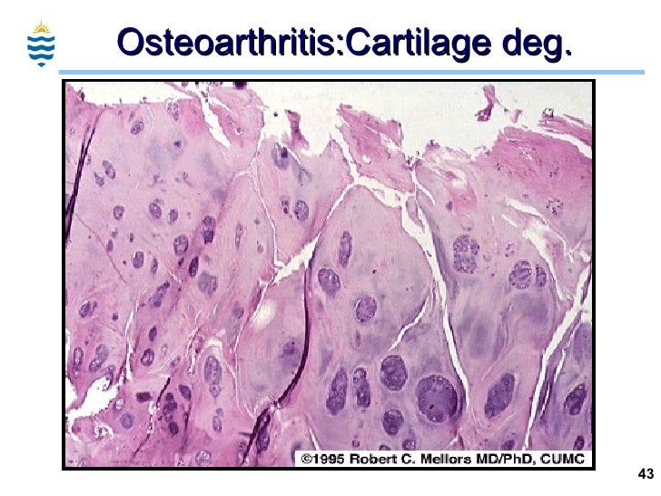 Pathology of Arthritis