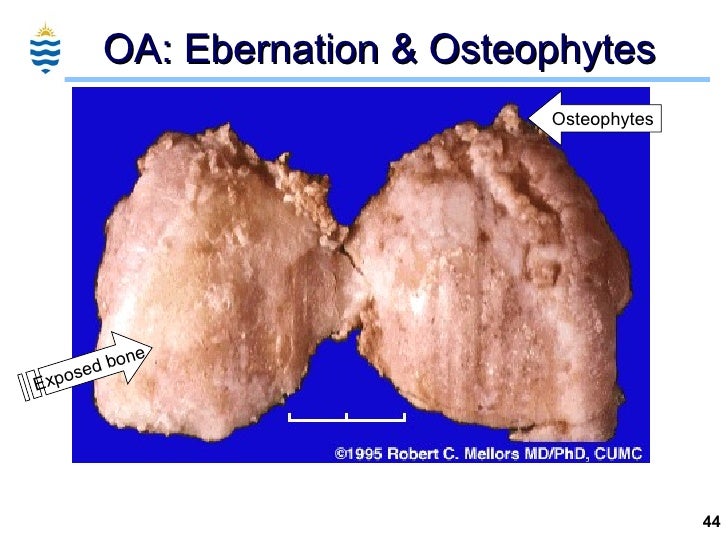 Pathology of Arthritis