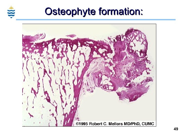 Pathology of Arthritis