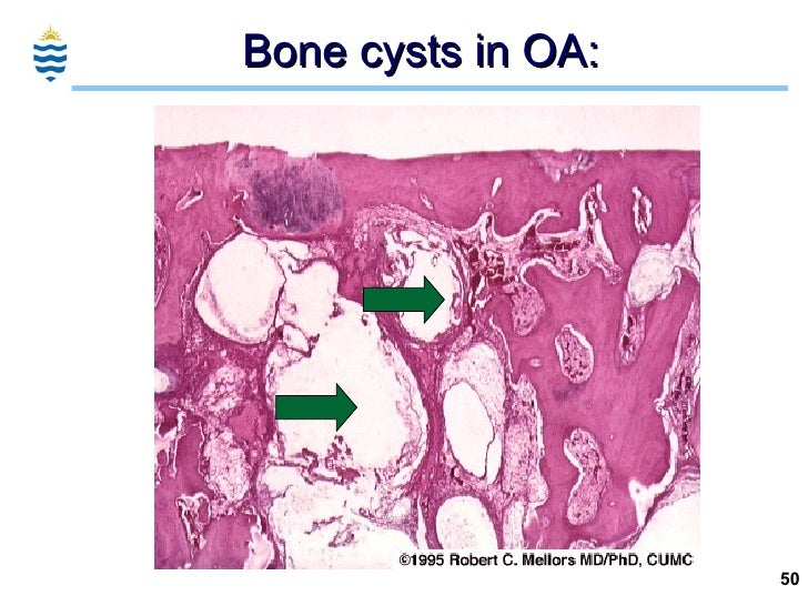 Pathology of Arthritis
