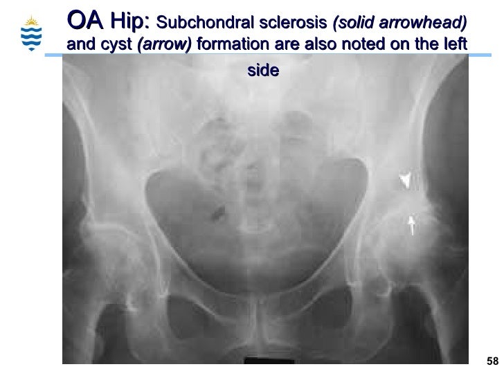 Pathology of Arthritis