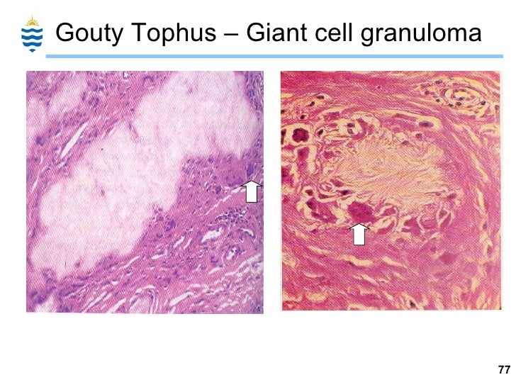 Gout Arthritis Histology at Lucinda Mccathie blog