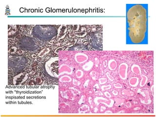 Pathology of Glomerulonephritis | PPT