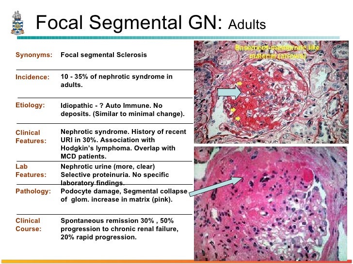Pathology of Glomerulonephritis