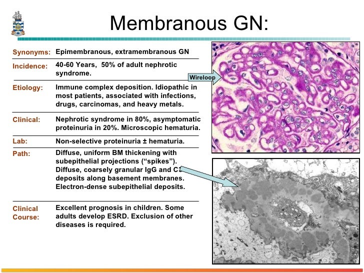 Pathology of Glomerulonephritis