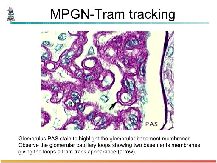 Pathology of Glomerulonephritis