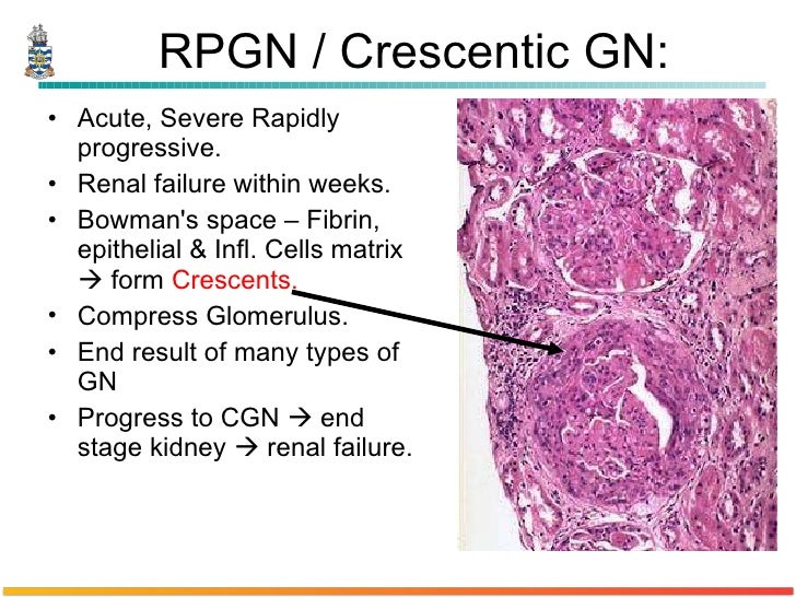 Pathology of Glomerulonephritis