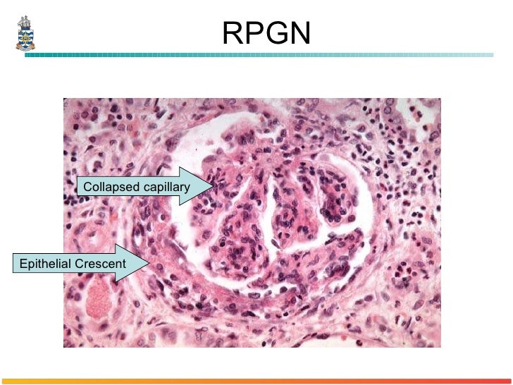 Pathology of Glomerulonephritis