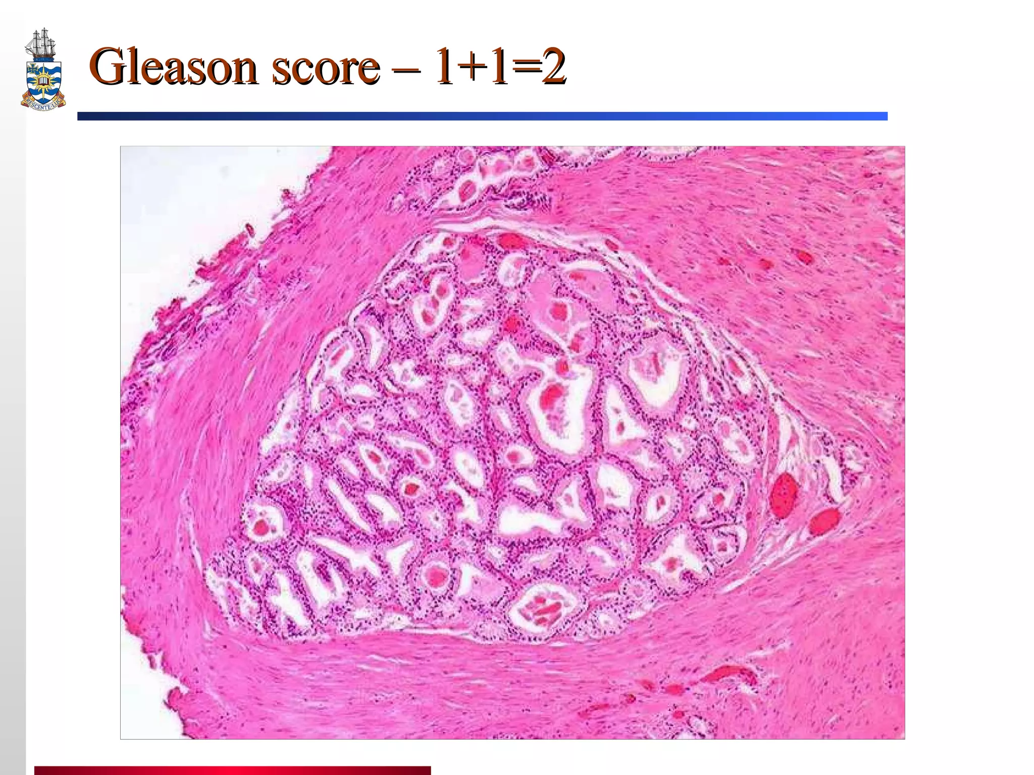 Pathology of Prostate | PPT