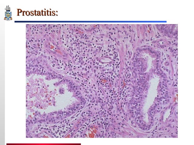 Pathology of Prostate | PPT