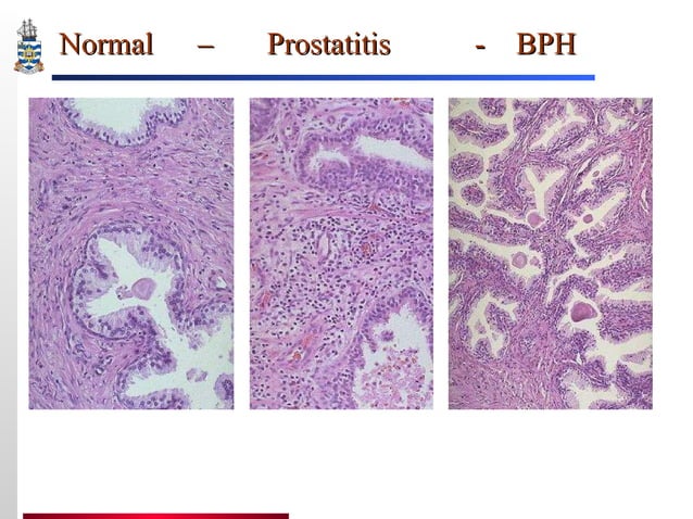 Pathology of Prostate | PPT