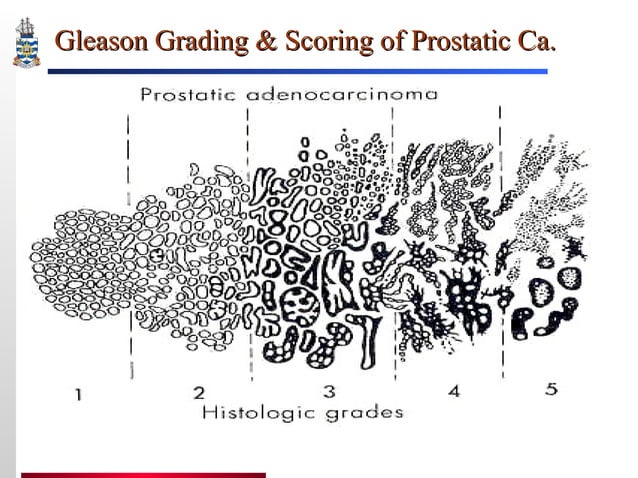 Pathology of Prostate | PPT