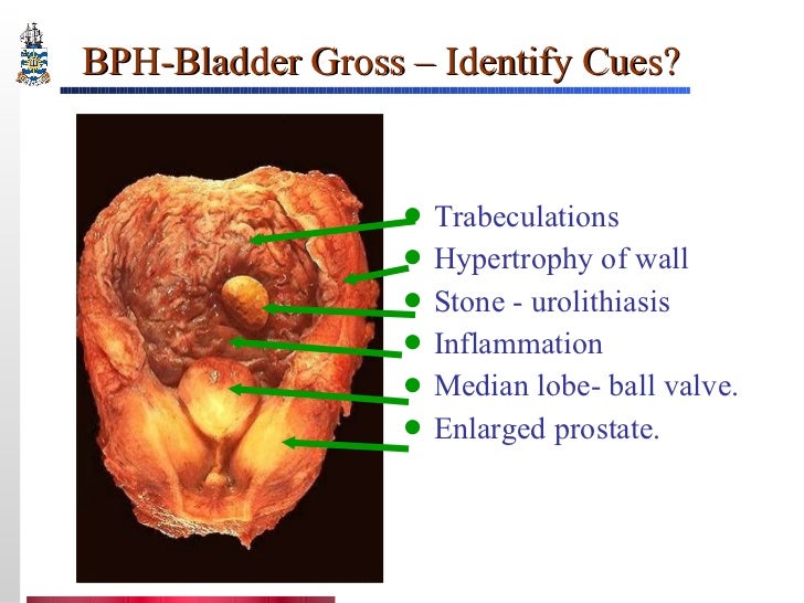 Pathology of Prostate