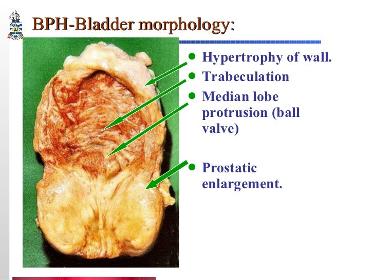 Pathology of Prostate