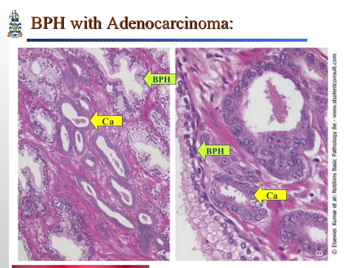 Benign Prostatic Hyperplasia Gross