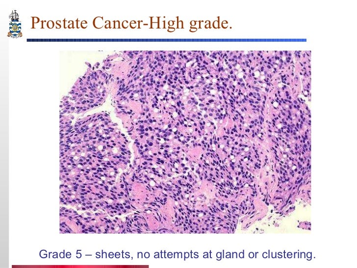 Pathology of Prostate