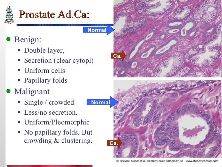 Pathology of Prostate