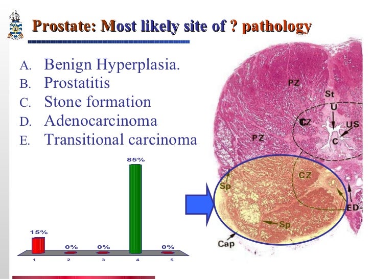 Pathology of Prostate