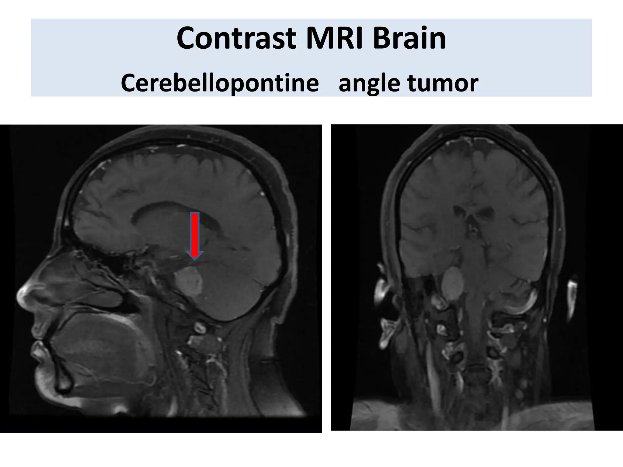 CPC - bilateral ear discharge and unilateral intermittent facial ...