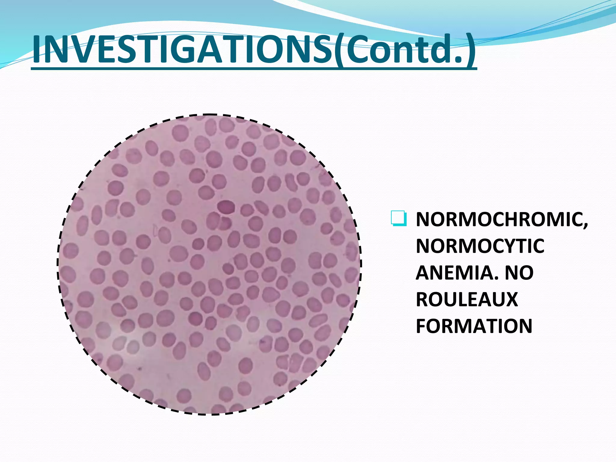 Plasma Cell Dyscrasias.pptx