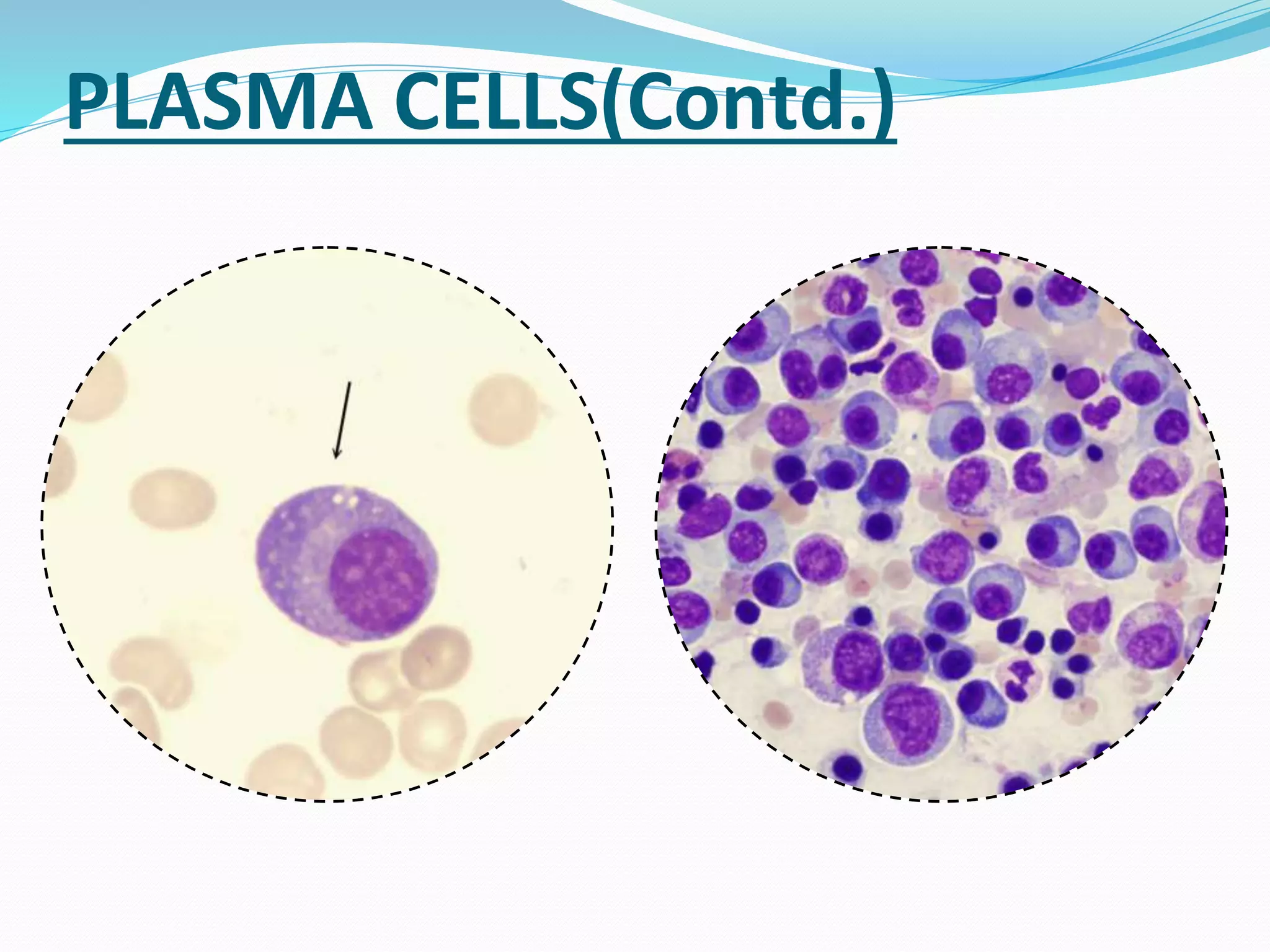 Plasma Cell Dyscrasias.pptx