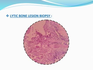 Plasma Cell Dyscrasias.pptx