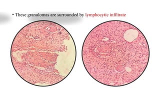 CPC- Synovitis granulomatous- histopathology | PPTX