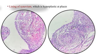 HISTOPATHOLOGY OF GRANULOMATOUS SYNOVITIS | PPTX