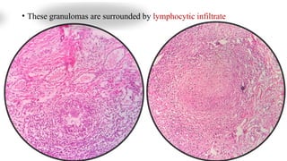 HISTOPATHOLOGY OF GRANULOMATOUS SYNOVITIS | PPTX