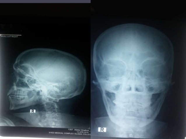 Hyperviscosity syndrome CPC | PPT