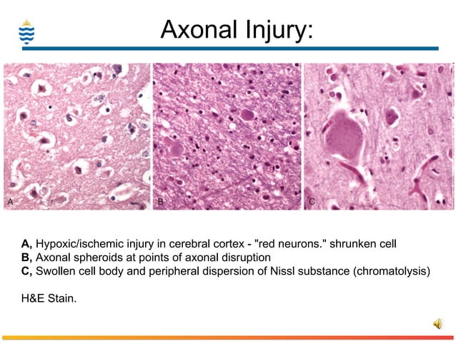 Pathology of Stroke-CVA | PPT | Brain and Nervous System Disorders | Diseases and Conditions