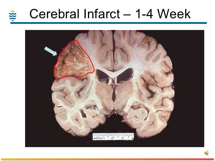 Pathology of Stroke-CVA