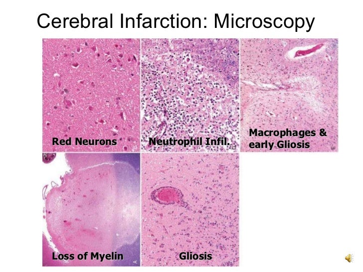 Pathology of Stroke-CVA