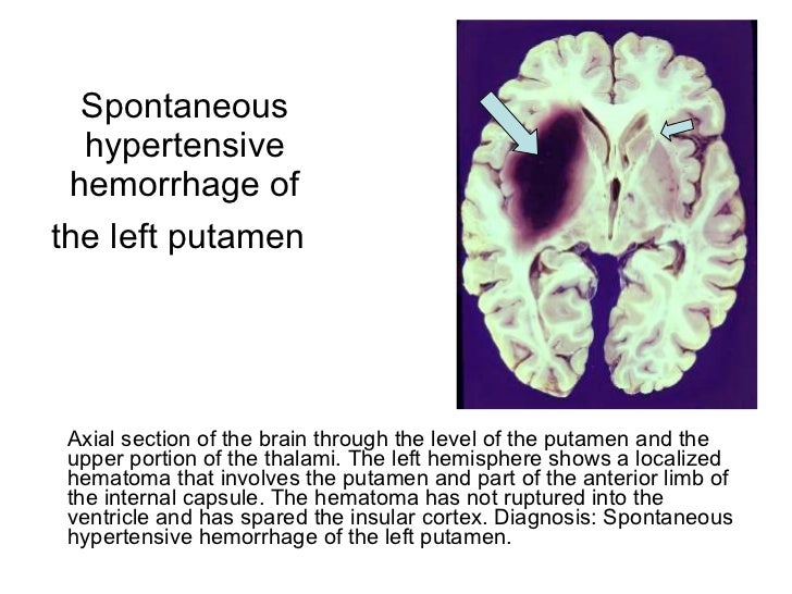 Pathology of Stroke-CVA