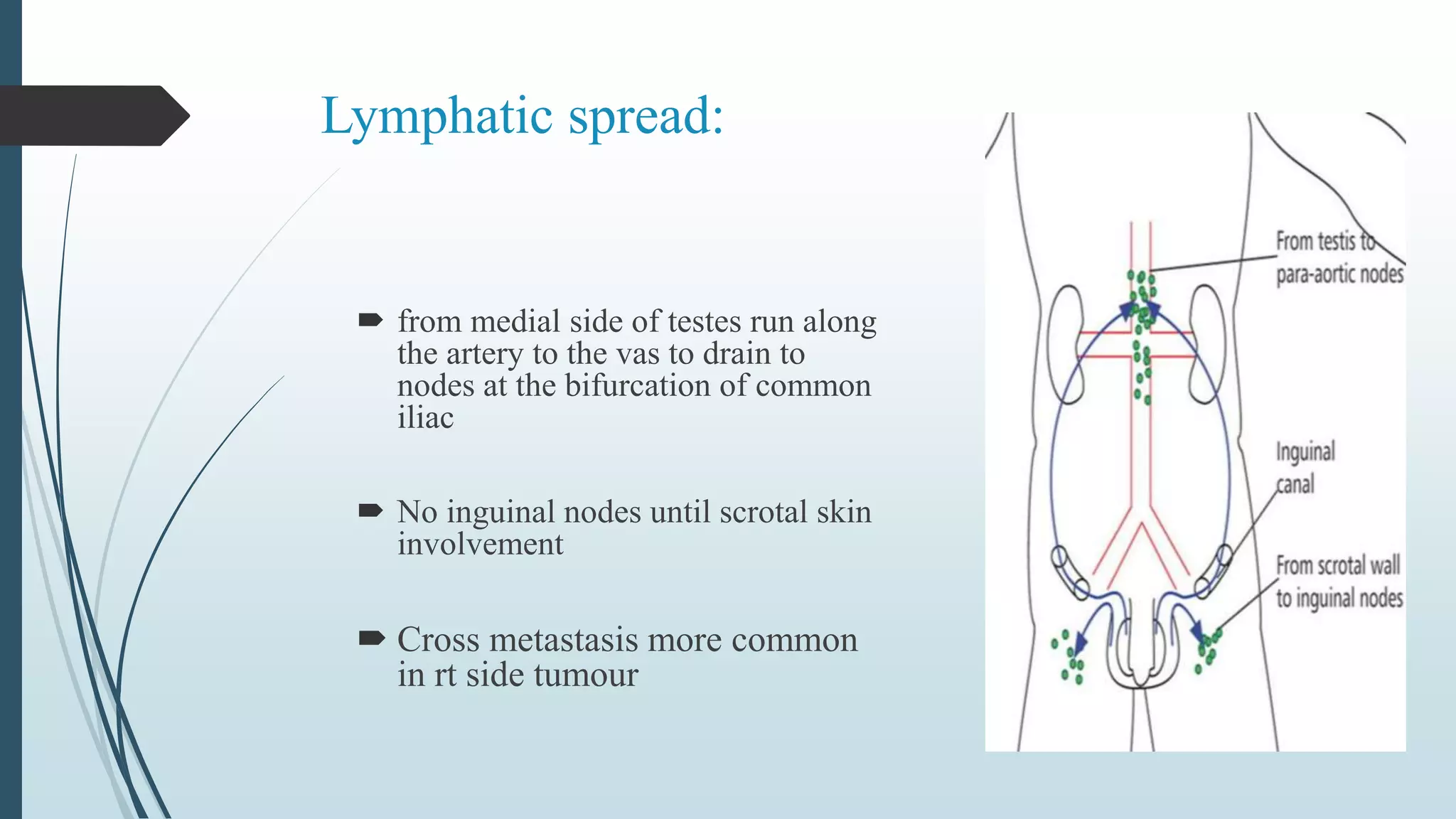testicular tumor | PPTX