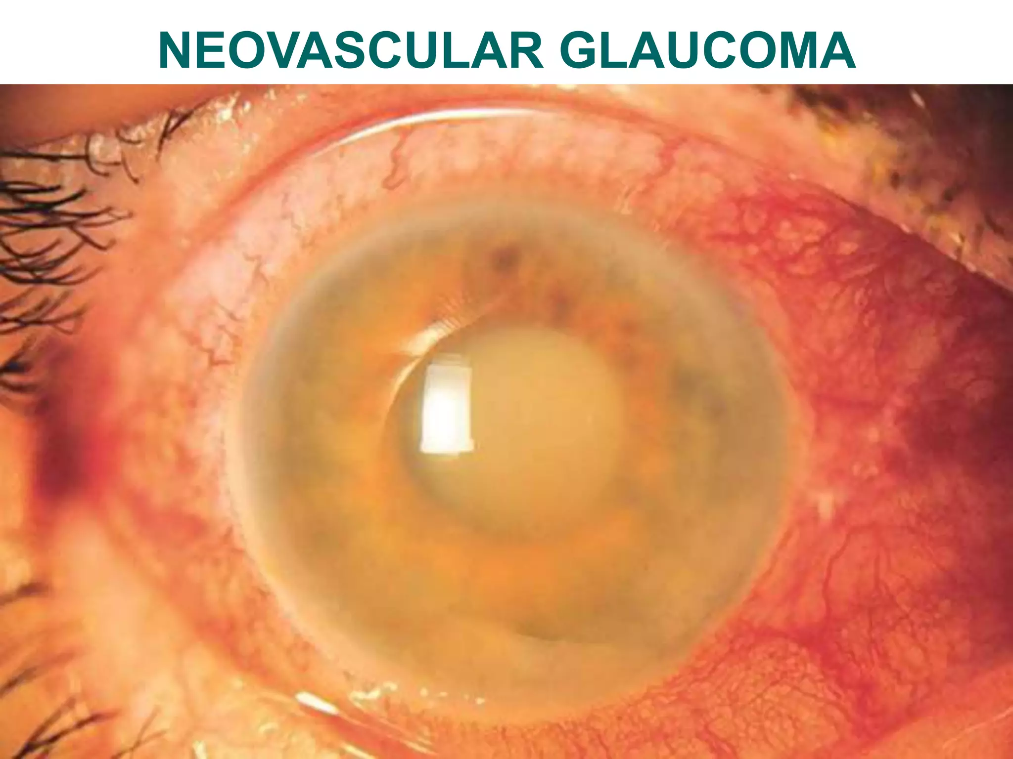 CYCLODIODE LASER FOR GLAUCOMA -AJAY DUDANI | PPT