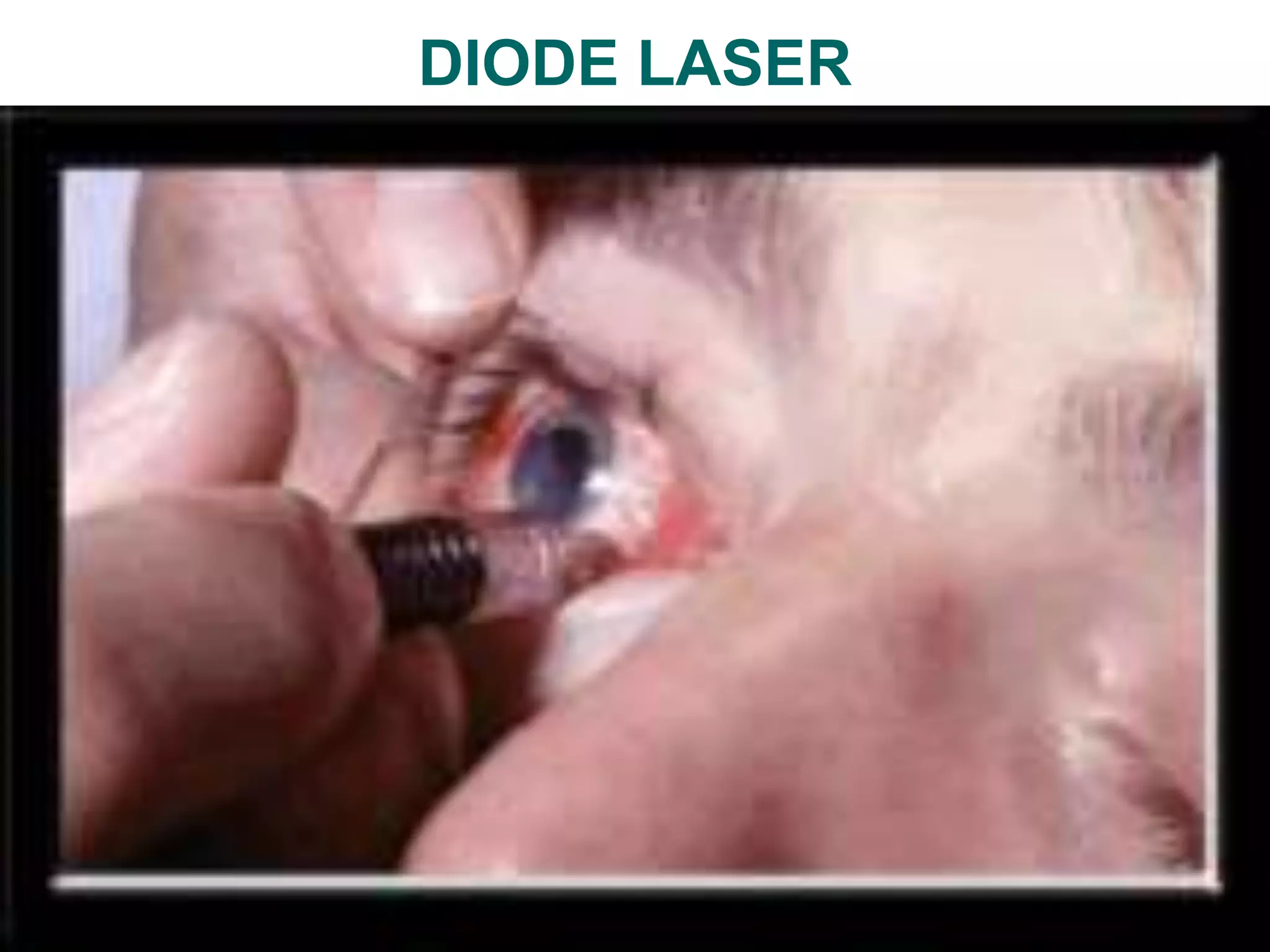 CYCLODIODE LASER FOR GLAUCOMA -AJAY DUDANI | PPT