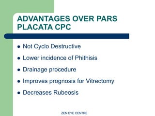 CYCLODIODE LASER FOR GLAUCOMA -AJAY DUDANI | PPT