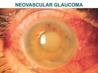 CYCLODIODE LASER FOR GLAUCOMA -AJAY DUDANI | PPT