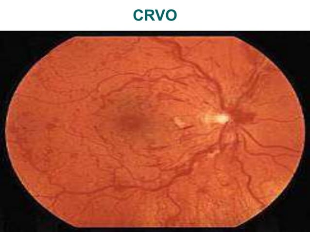 CYCLODIODE LASER FOR GLAUCOMA -AJAY DUDANI | PPT